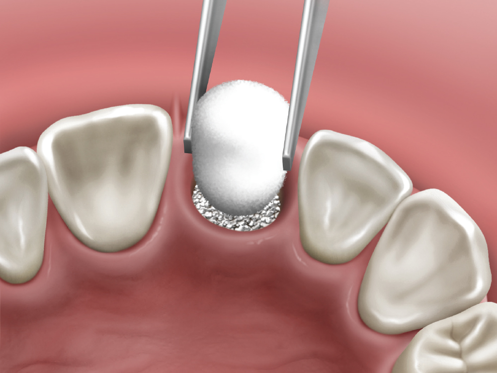 Socket Grafting: When to Graft and What to Use