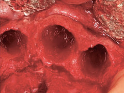 Socket Grafting: When to Graft and What to Use