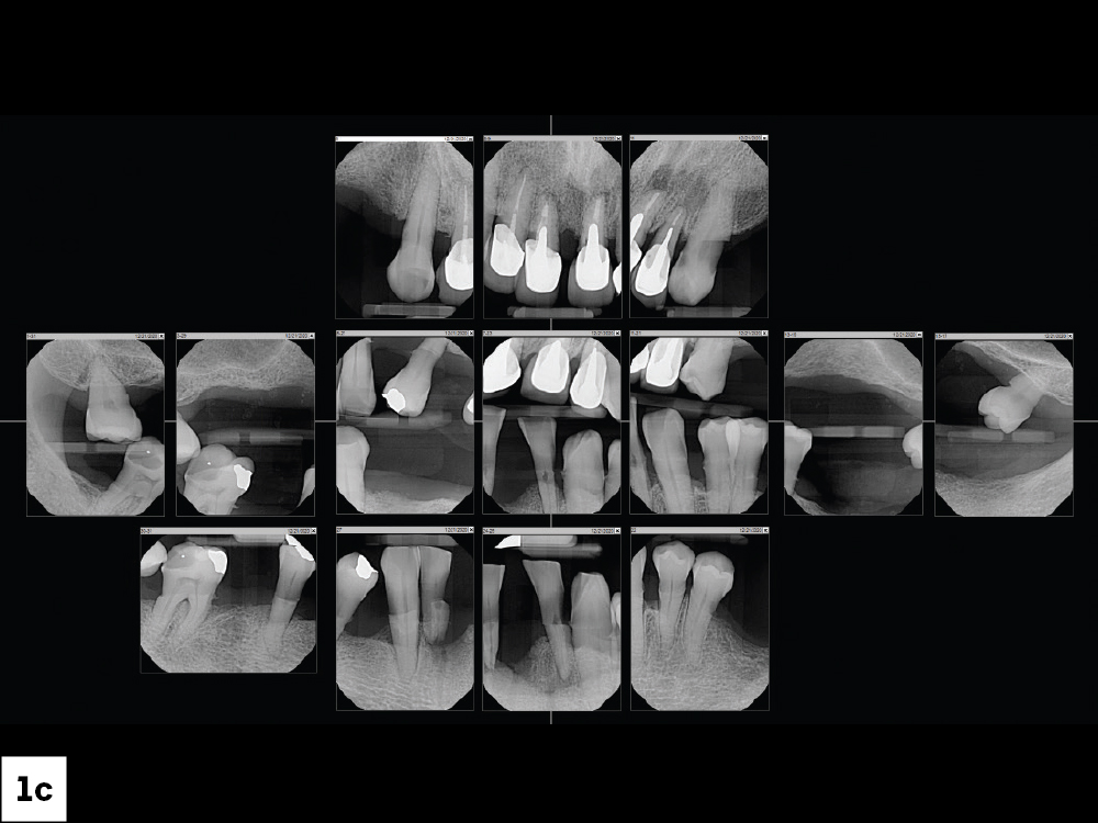 Implant-Retained Mandibular Overdentures
