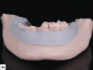 Implant-Retained Mandibular Overdentures