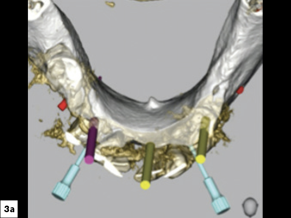 Implant-Retained Mandibular Overdentures