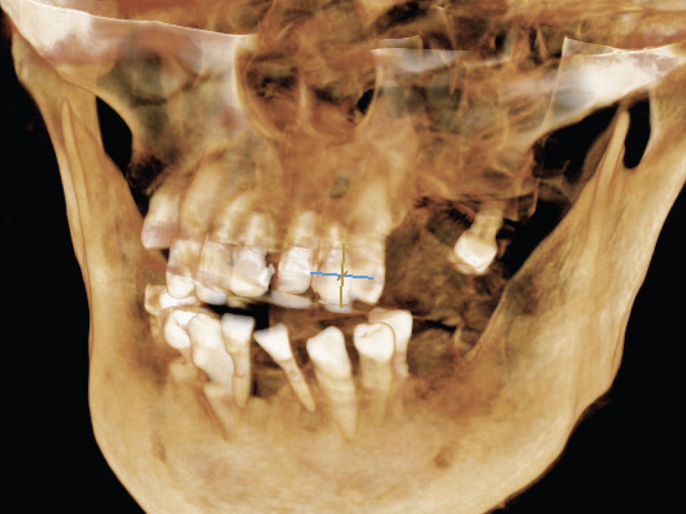 Implant-Retained Mandibular Overdentures