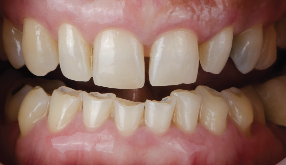 How to Choose the Right Nightguard for Your Patients