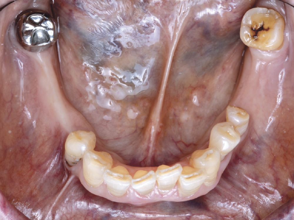 Dental Case: Making a Crown Beneath an Existing Partial