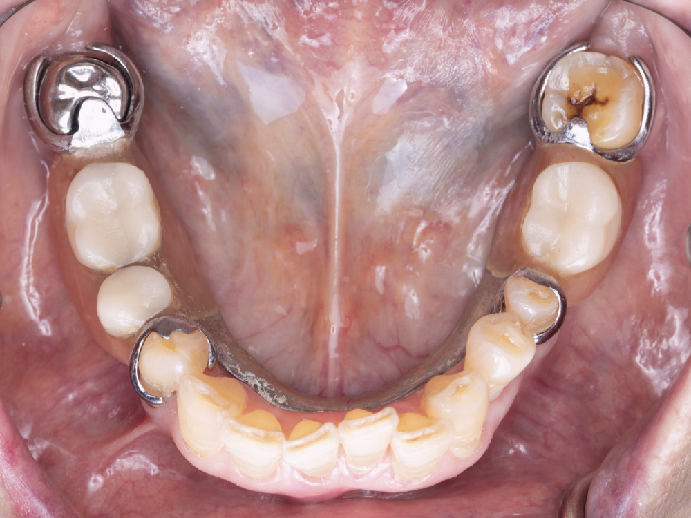 Dental Case: Making a Crown Beneath an Existing Partial
