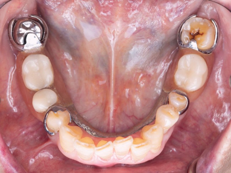 Dental Case: Making a Crown Beneath an Existing Partial