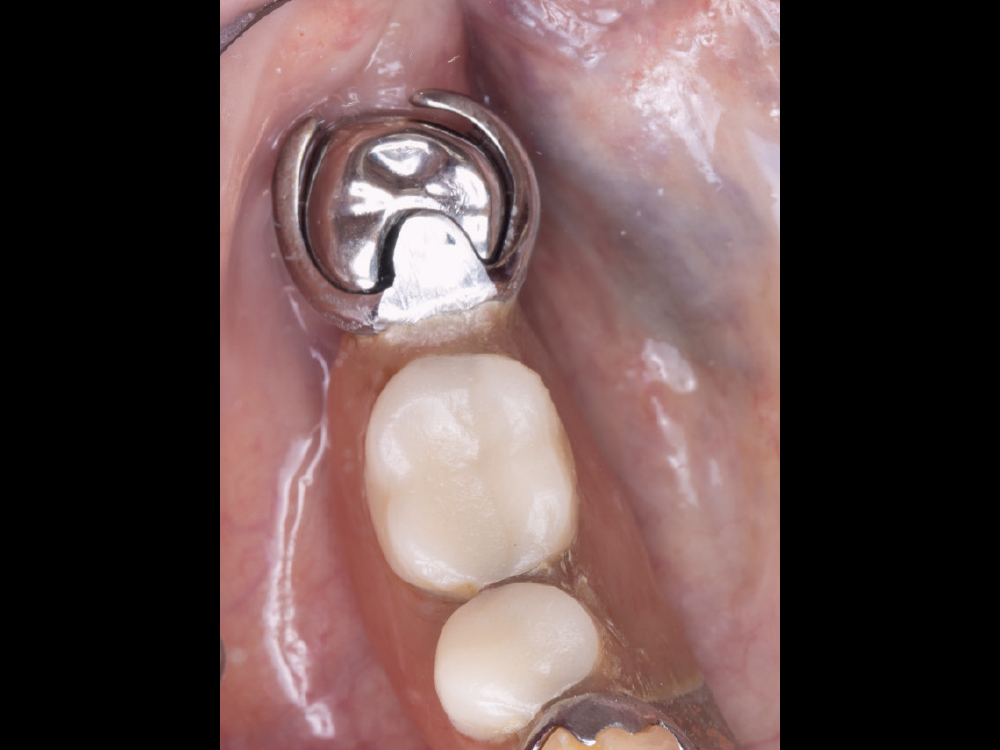 Dental Case: Making a Crown Beneath an Existing Partial