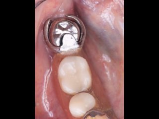 Dental Case: Making a Crown Beneath an Existing Partial