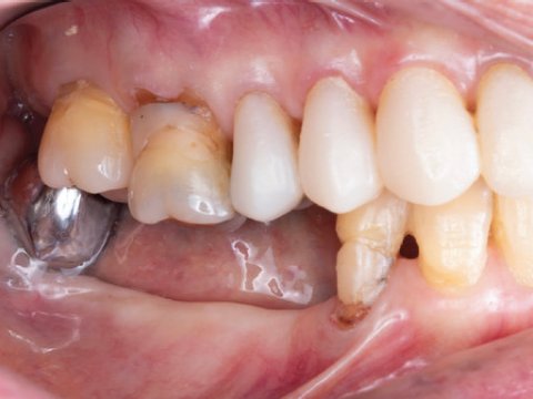 Dental Case: Making a Crown Beneath an Existing Partial