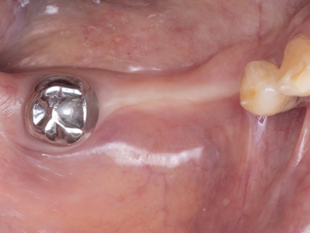 Dental Case: Making a Crown Beneath an Existing Partial