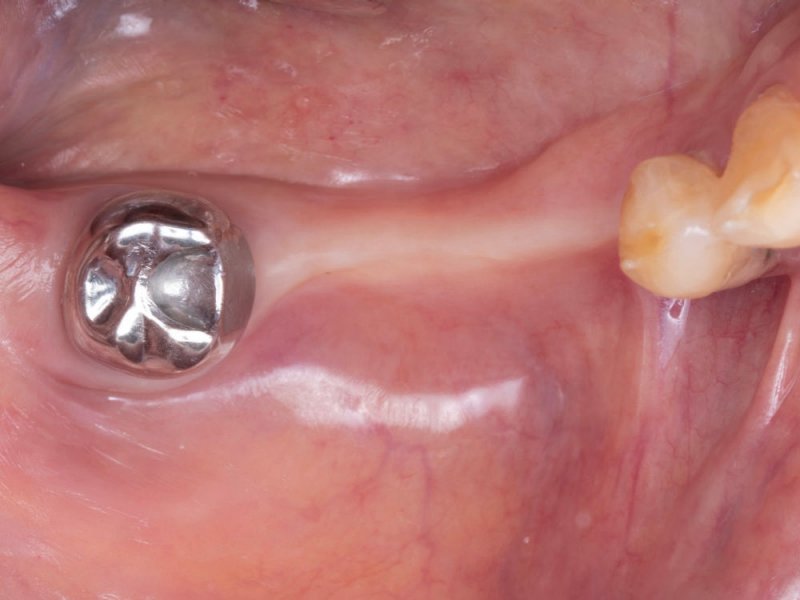 Dental Case: Making a Crown Beneath an Existing Partial