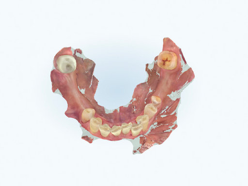 Dental Case: Making a Crown Beneath an Existing Partial