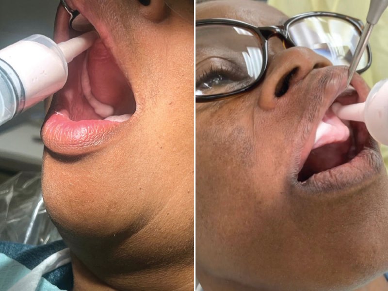 Dental Impression Materials & Approach for Complete Dentures