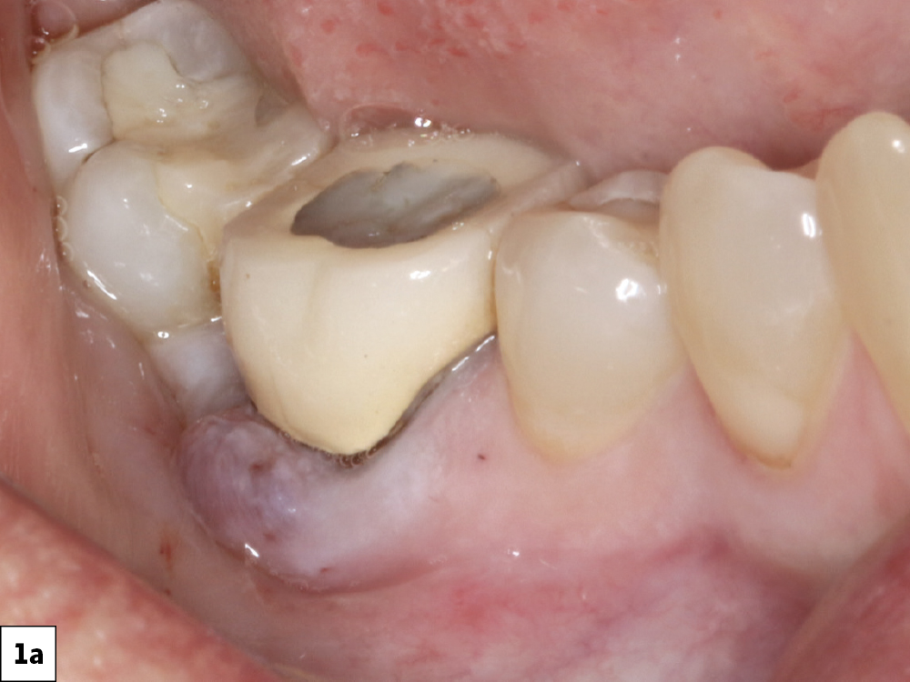 Socket Grafting and Implant Placement: A Simplified Approach