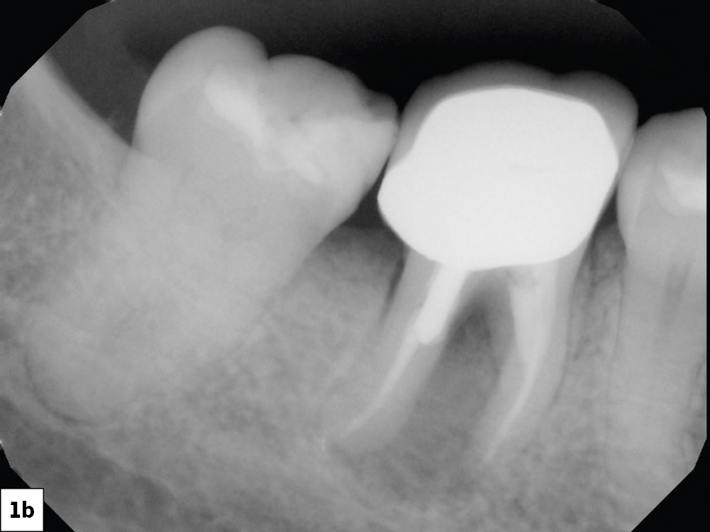 Socket Grafting and Implant Placement: A Simplified Approach