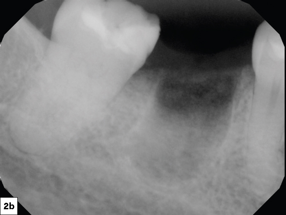 Socket Grafting and Implant Placement: A Simplified Approach