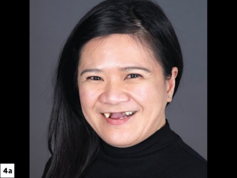 Test-Drive Future Treatment with Smile Transitions™