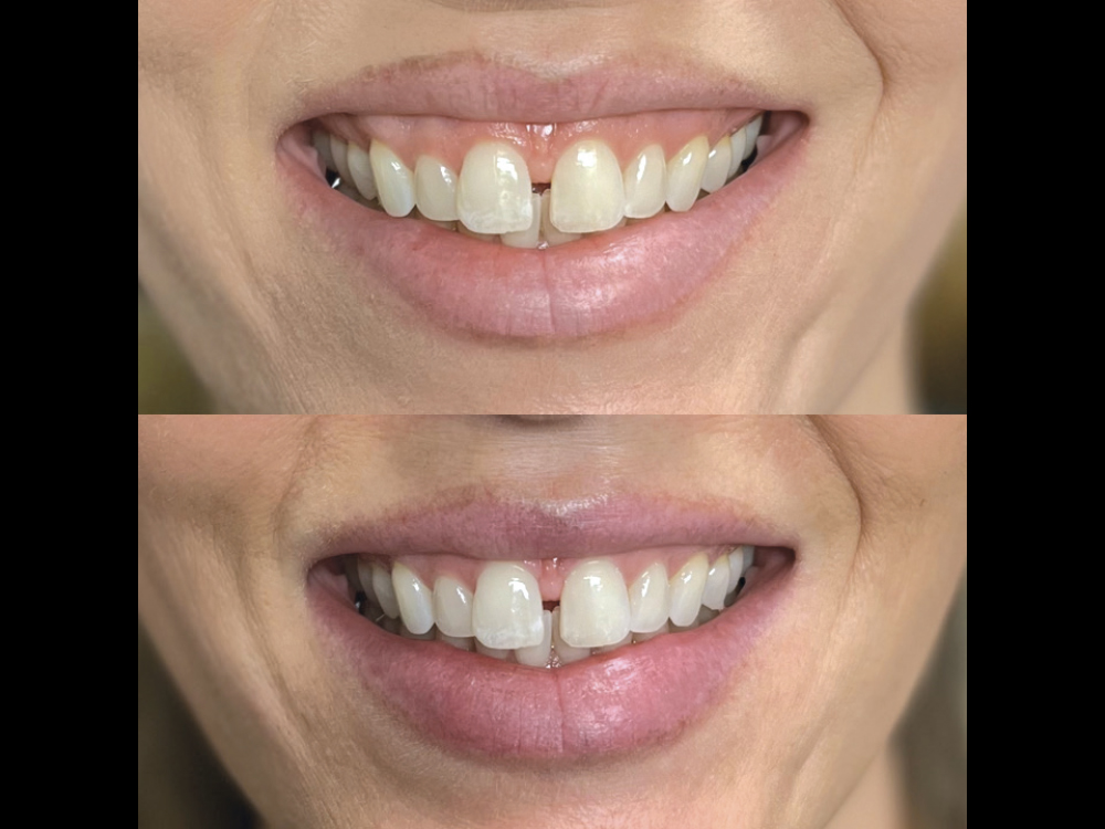How Do Neurotoxins Work in Esthetic Dentistry?