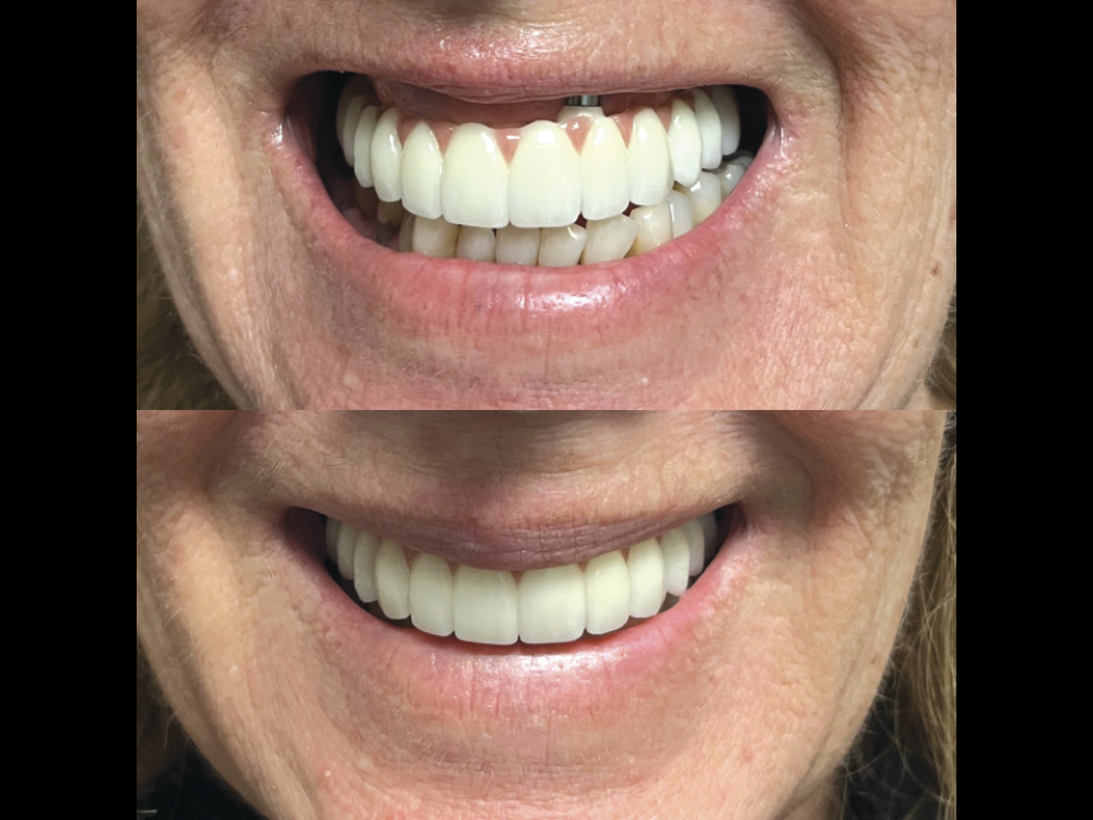 How Do Neurotoxins Work in Esthetic Dentistry?