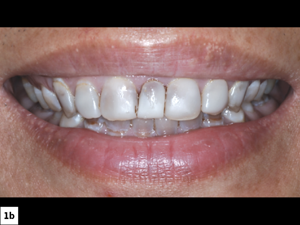 Mesiodens & Tetracycline Staining: Solving the Challenge