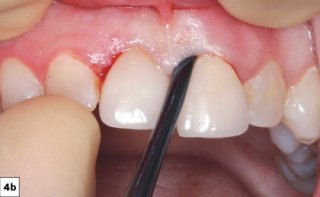 Socket Grafting & Immediate Implant Placement: Esthetic Zone