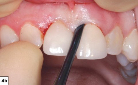 Socket Grafting & Immediate Implant Placement: Esthetic Zone