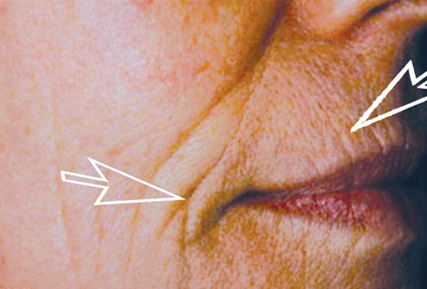 Facial Correction Without Injection: Angellift® Pricing and Technology ...