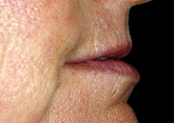 Facial Correction Without Injection: Angellift® Pricing and Technology ...