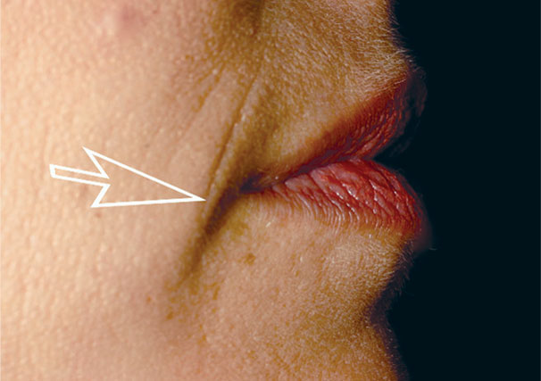 Facial Correction Without Injection: Angellift® Pricing and Technology ...