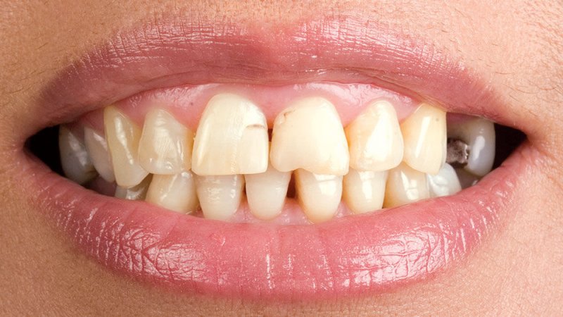 Clinical Technique: Diagnostic Wax-Ups