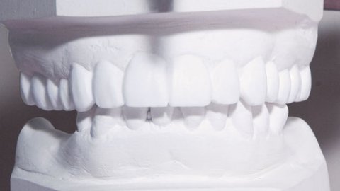 Clinical Technique: Diagnostic Wax-Ups