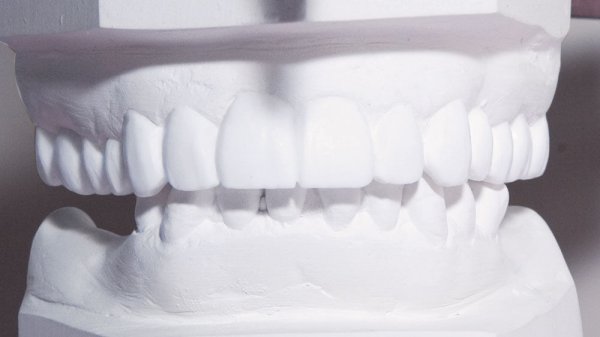 Clinical Technique: Diagnostic Wax-Ups