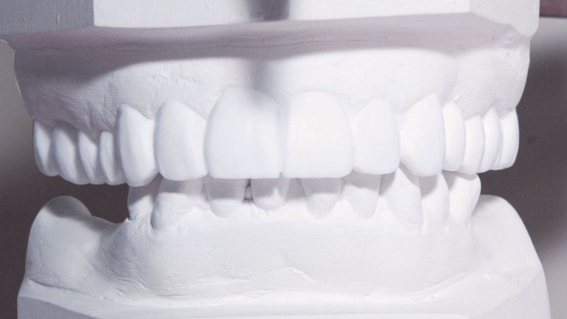 Clinical Technique: Diagnostic Wax-Ups