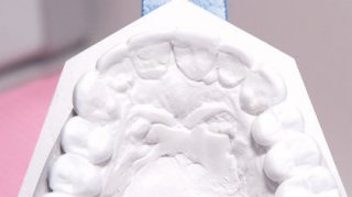 Clinical Technique: Diagnostic Wax-Ups