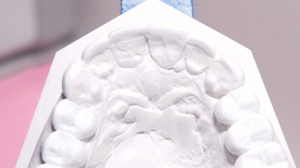 Clinical Technique: Diagnostic Wax-Ups