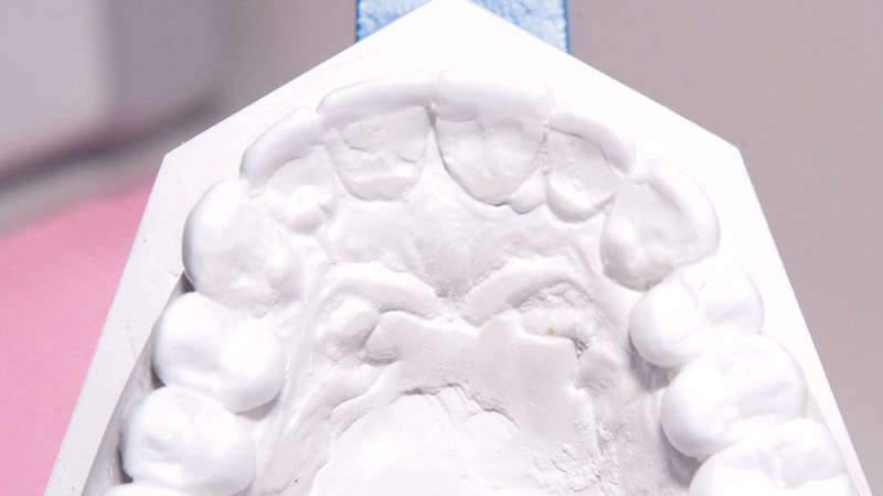 Clinical Technique: Diagnostic Wax-Ups