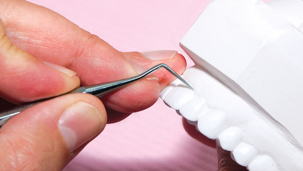 Clinical Technique: Diagnostic Wax-Ups