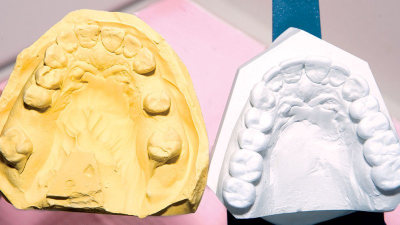 Clinical Technique: Diagnostic Wax-Ups