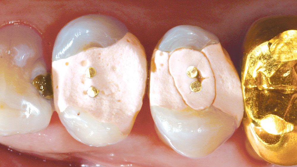 When Is a Full-Crown Restoration Indicated?