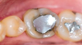 When Is a Full-Crown Restoration Indicated?