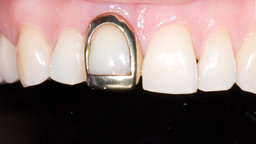 When Is a Full-Crown Restoration Indicated?