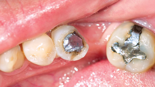 When Is a Full-Crown Restoration Indicated?