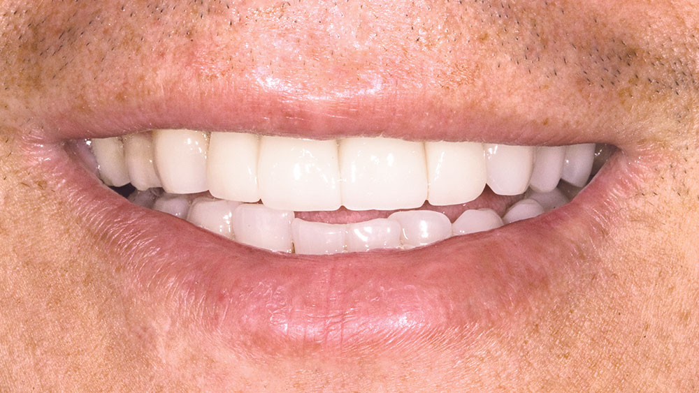 A Unique, Simplified Approach to Post/Buildup Placement with Lab ...