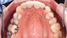 A Unique, Simplified Approach to Post/Buildup Placement with Lab ...