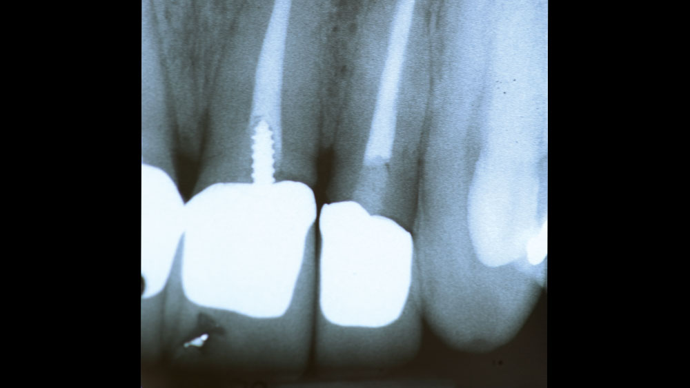A Unique, Simplified Approach to Post/Buildup Placement with Lab ...