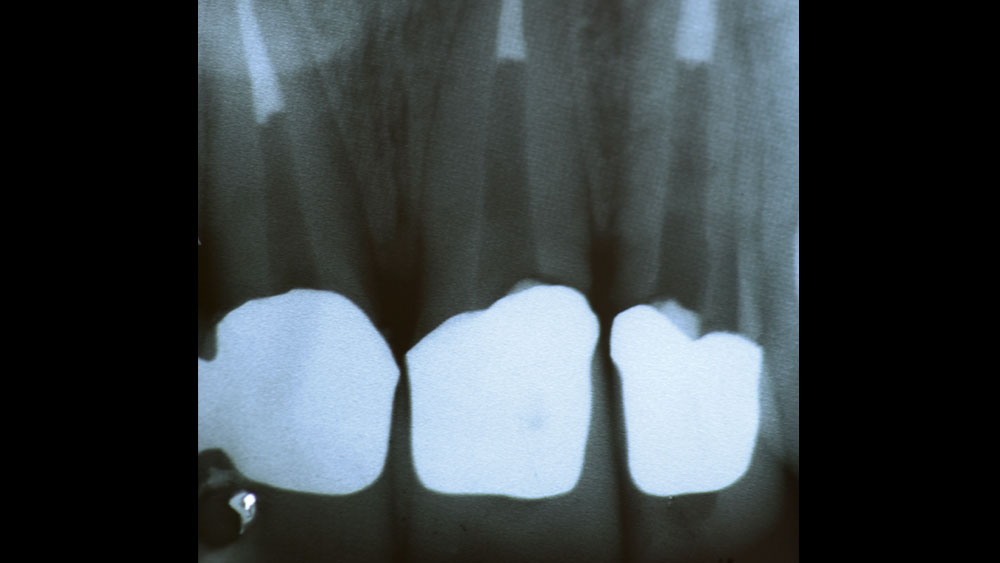 A Unique, Simplified Approach to Post/Buildup Placement with Lab ...
