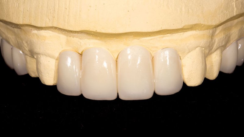 A Unique, Simplified Approach to Post/Buildup Placement with Lab ...