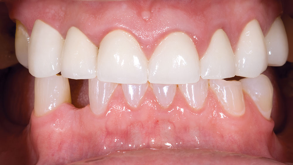 Captek Bridge & Implant™ Expands Clinical Indications