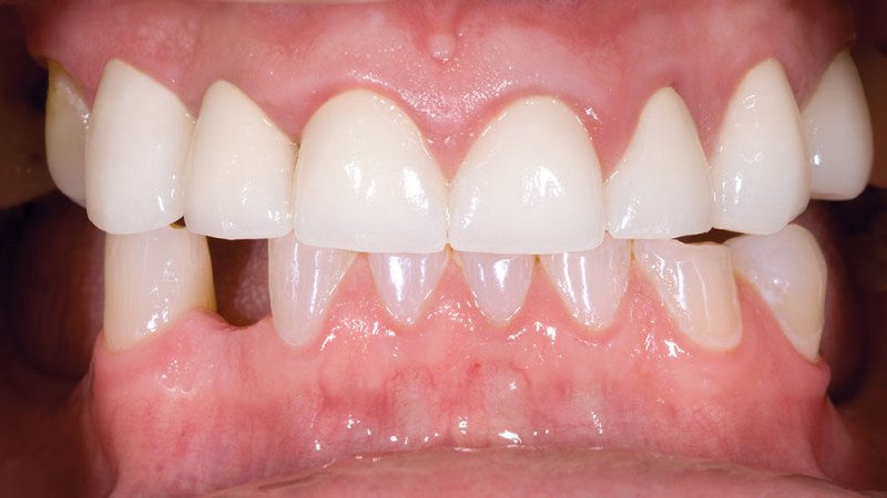 Captek Bridge & Implant™ Expands Clinical Indications