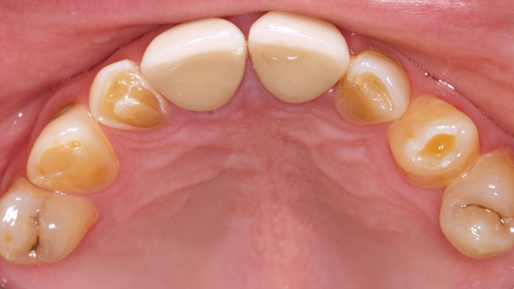 Captek Bridge & Implant™ Expands Clinical Indications